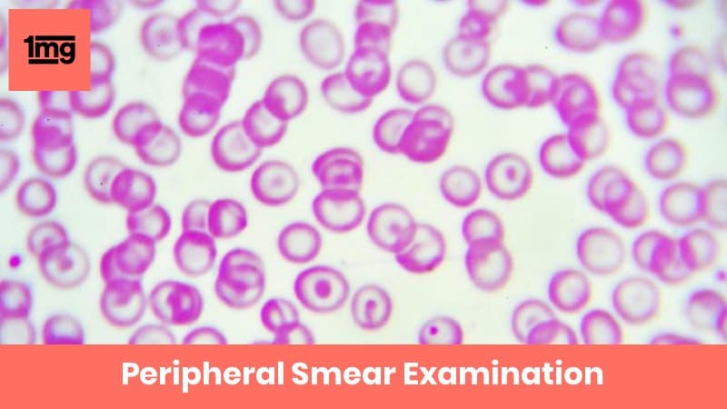 Peripheral Smear Examination (P/S): Purpose & Normal Range of Results | 1mg