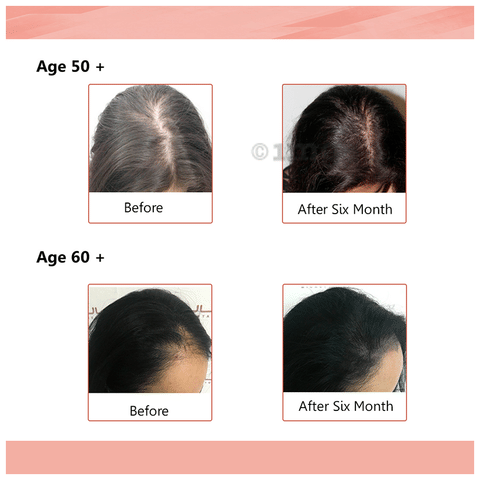 Folic Acid And Hair Loss